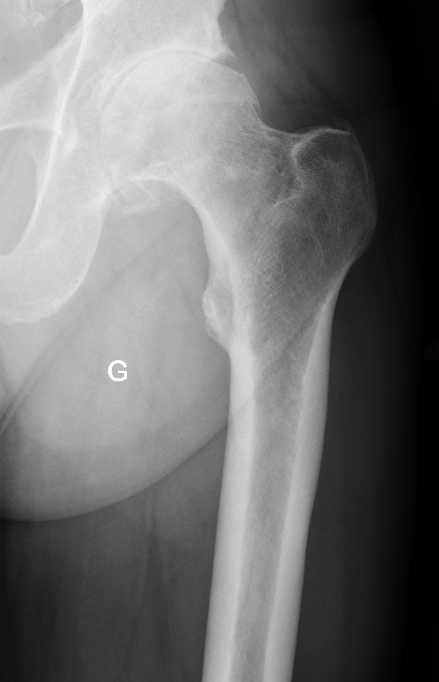 Suppression du risque de luxation après prothèse de hanche ...