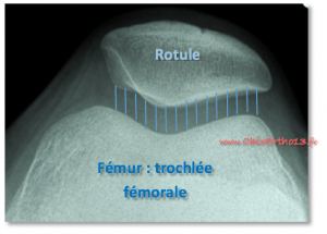 Douleur de la rotule Syndrome rotulien fémoro-patellaire - ChirOrtho13.fr